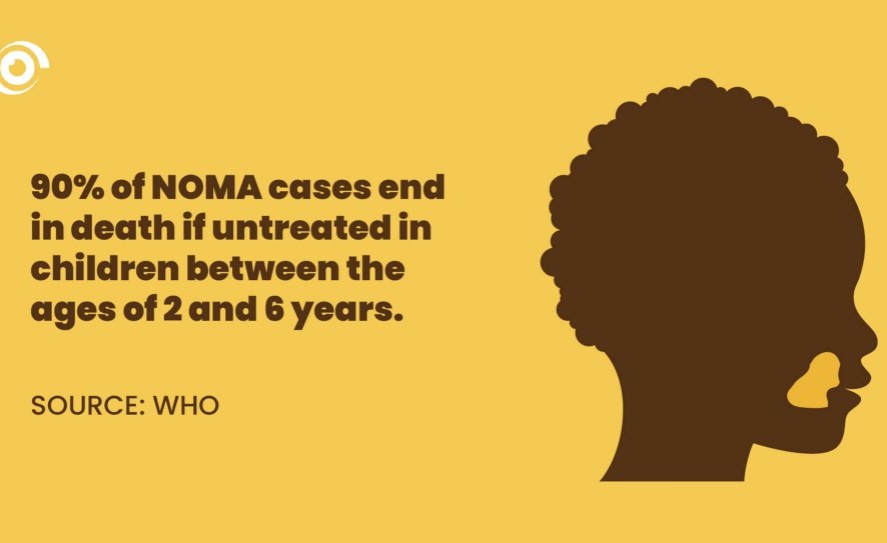 Nigeria Seeks Inclusion of Noma as a Neglected Tropical Disease ...
